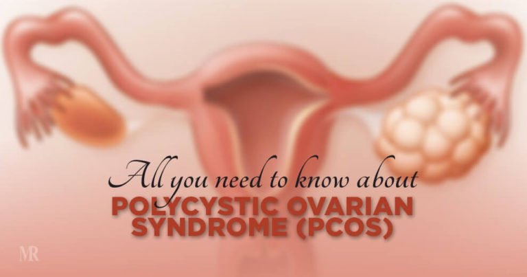 All you need to know about Polycystic Ovarian Syndrome (PCOS)
